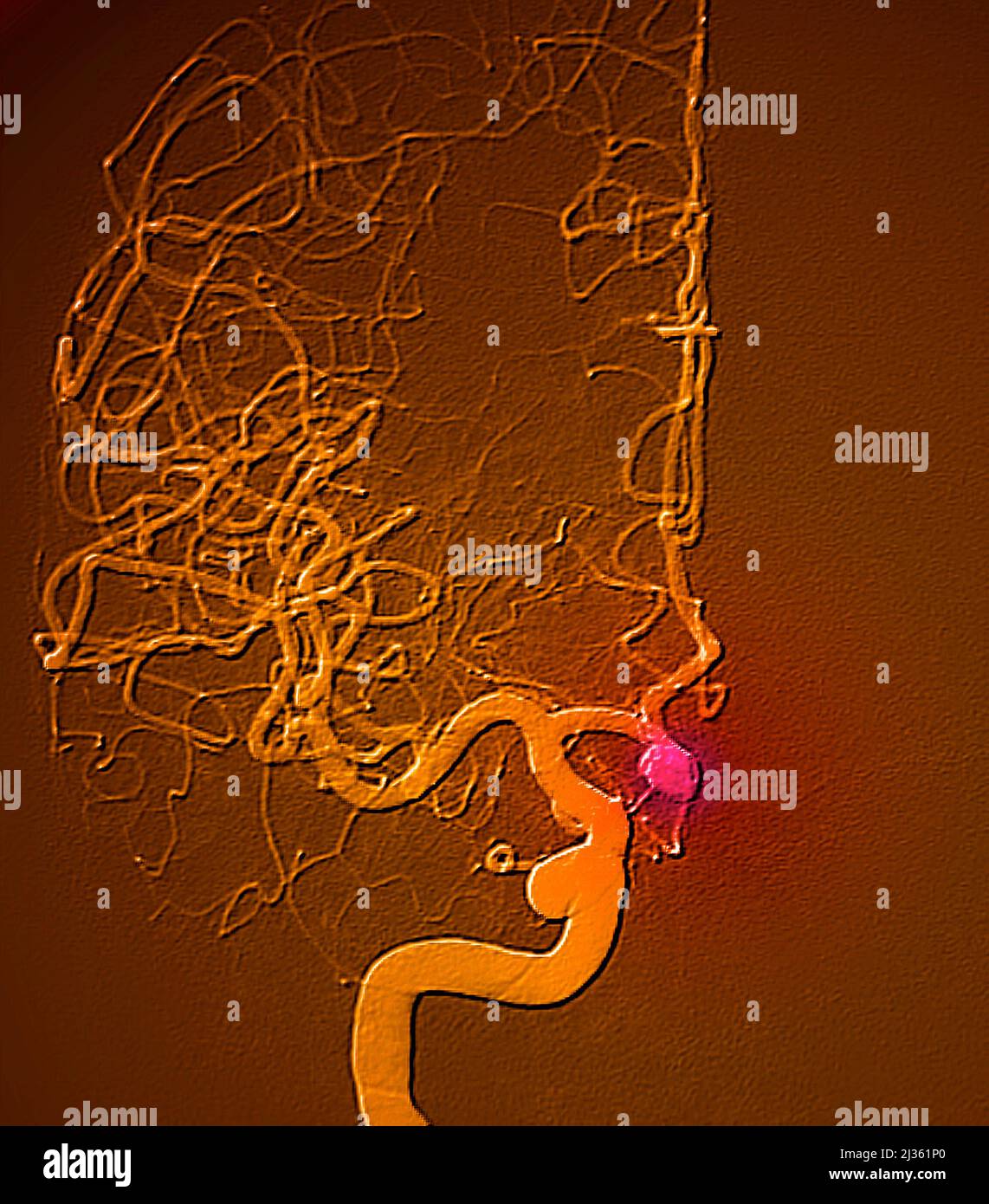 Brain aneurysm, angiogram Stock Photo - Alamy