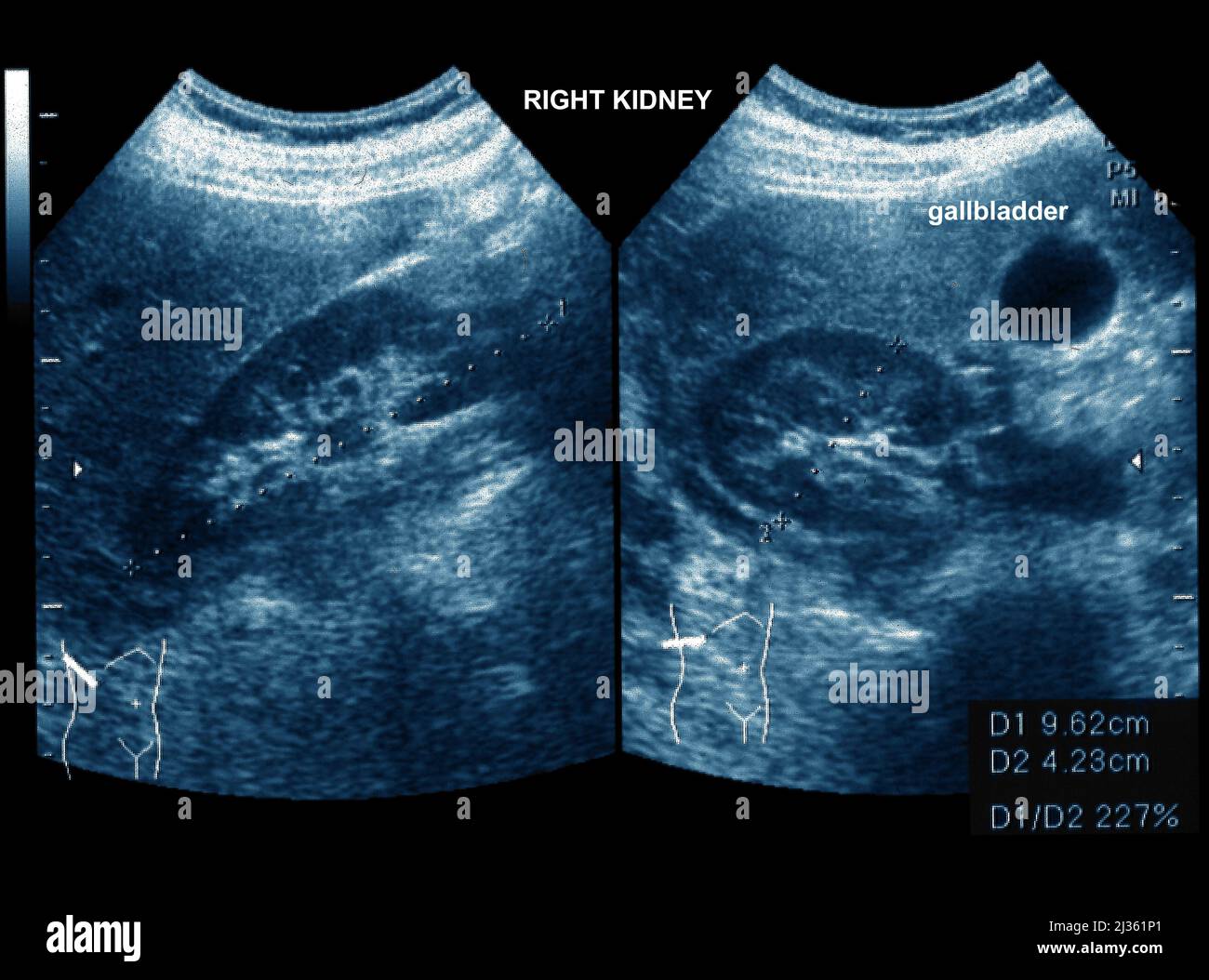 Normal gallbladder and kidney, ultrasound scans Stock Photo - Alamy