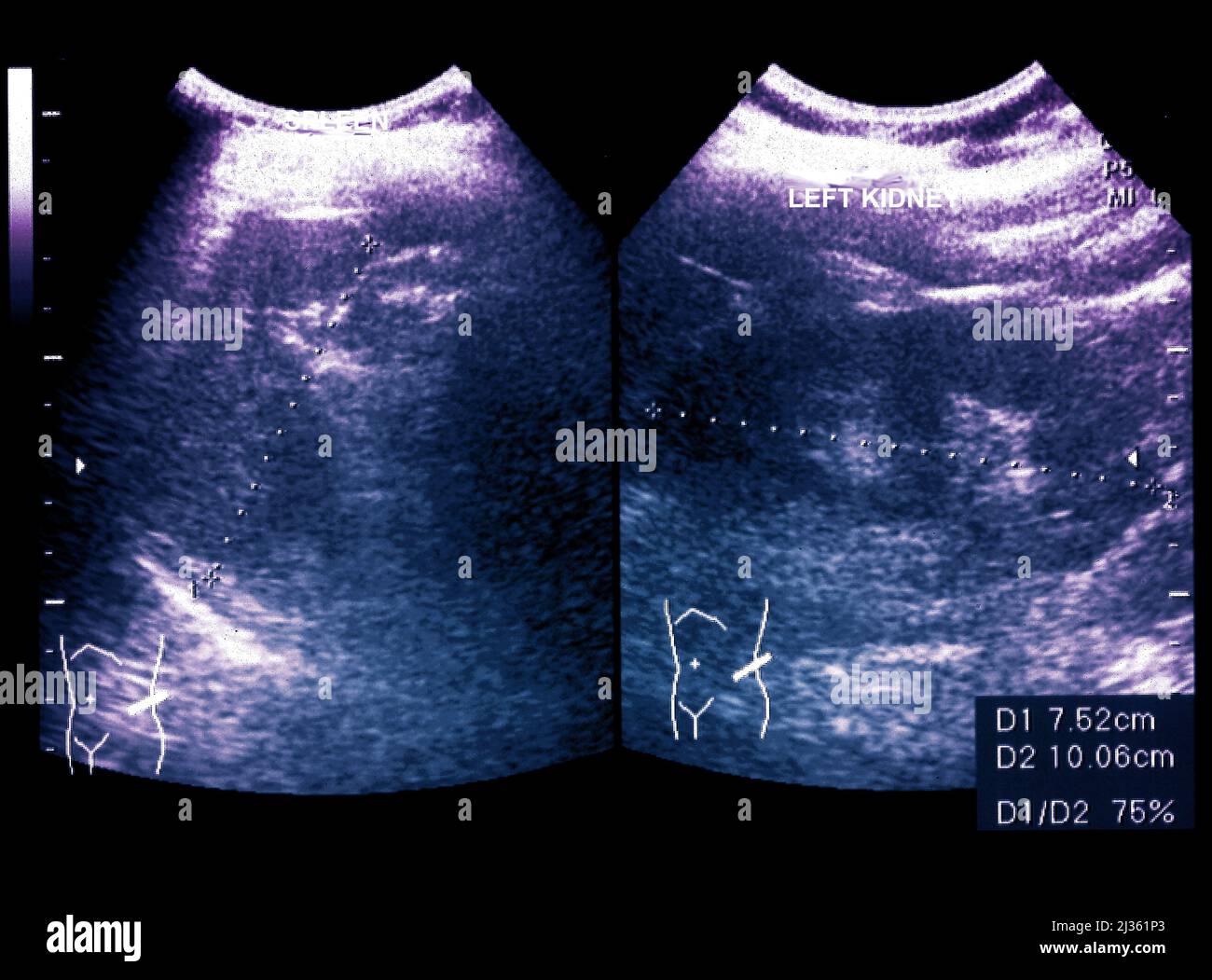Normal spleen and left kidney, ultrasound scans Stock Photo - Alamy
