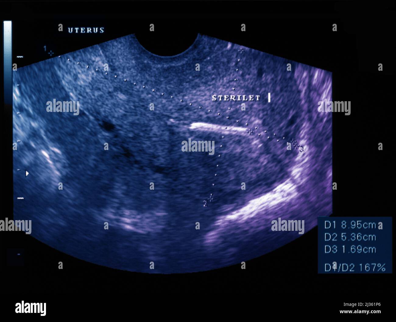 Normal uterus with IUD device, ultrasound scan Stock Photo - Alamy