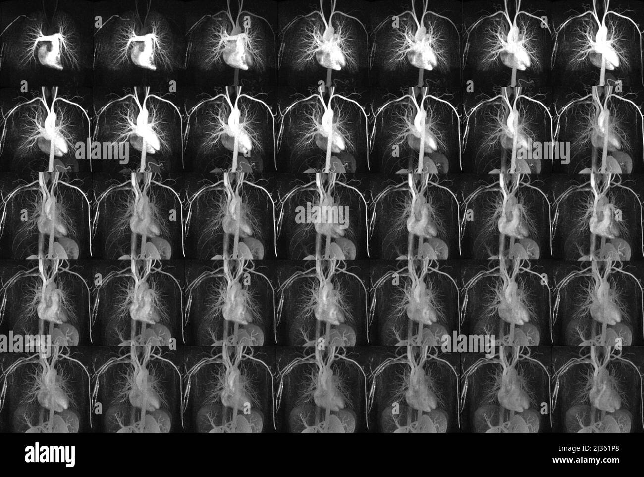 Circulatory system, MRI angiograms Stock Photo - Alamy