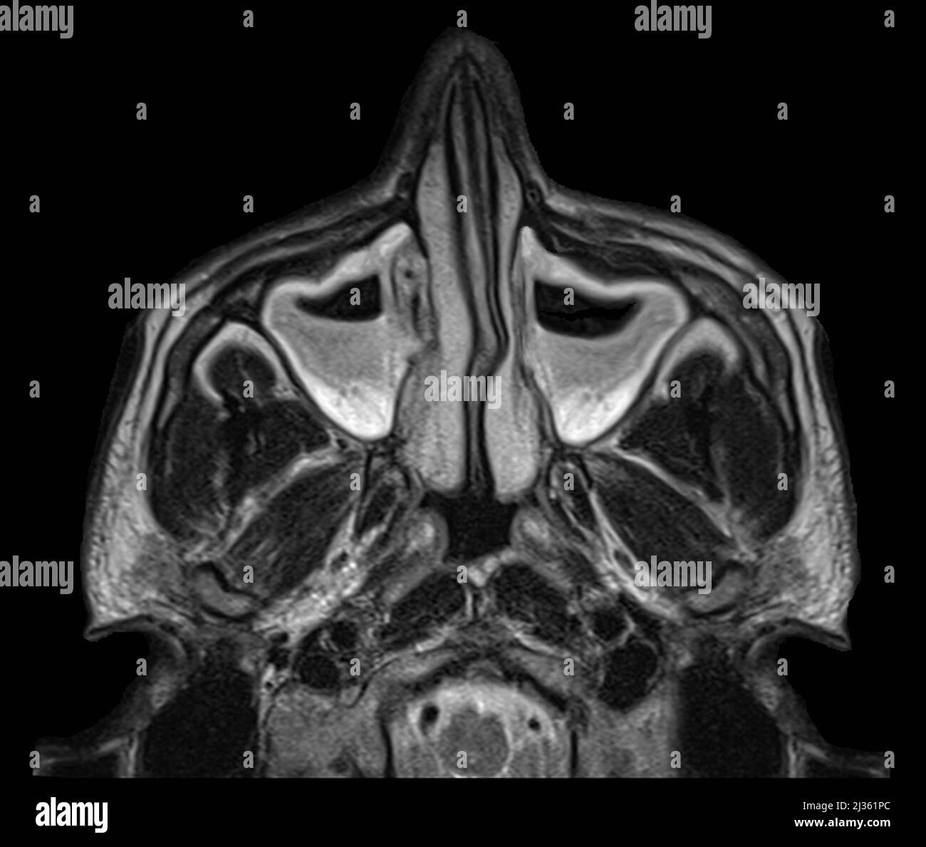 Sinusitis, MRI scan Stock Photo - Alamy