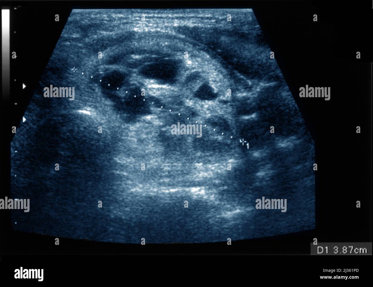 Thyroid nodule, ultrasound scan Stock Photo - Alamy Thyroid nodule, ultrasound scan Stock Photo - Alamy