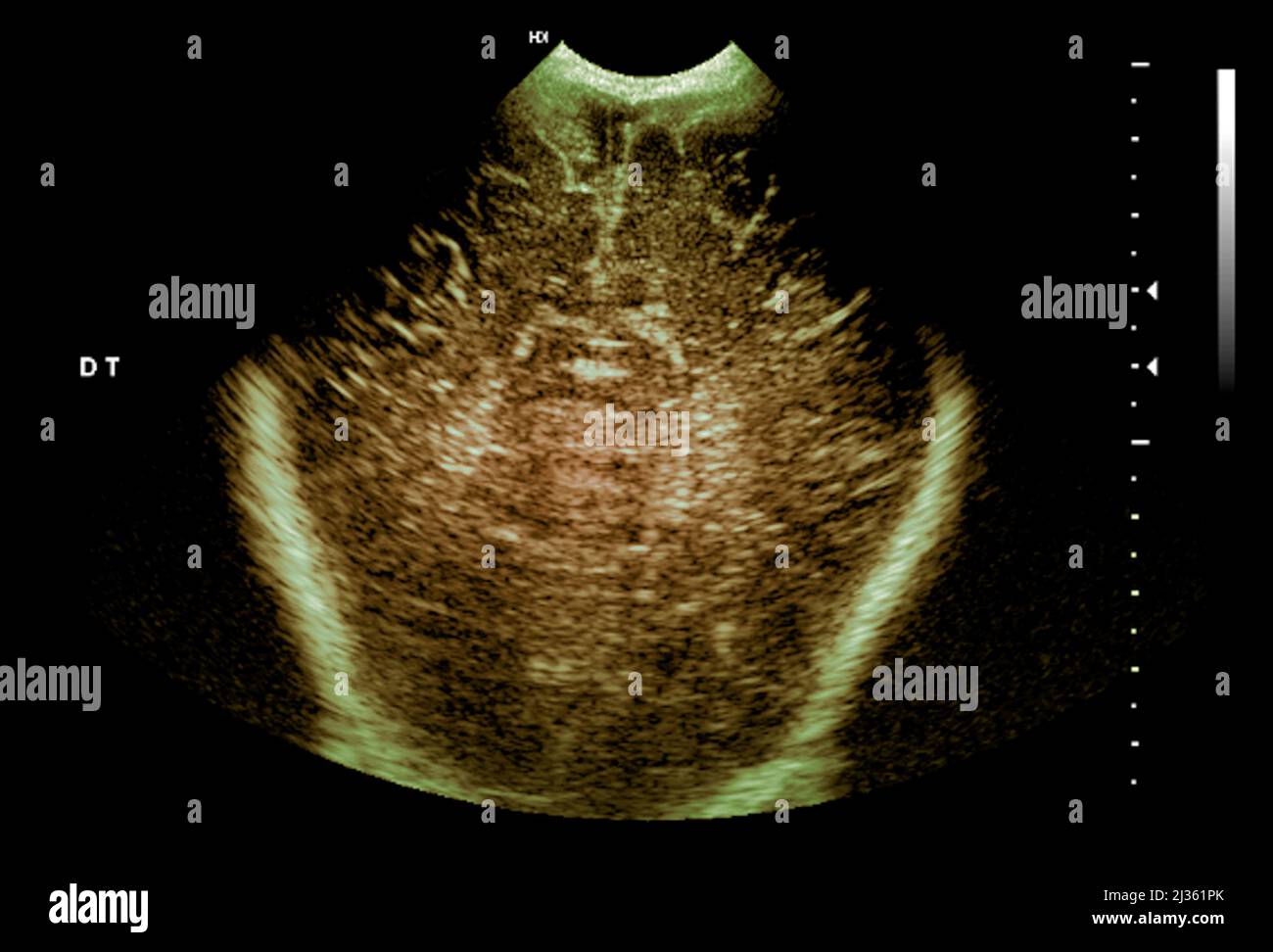 Normal premature newborn baby brain development, ultrasound Stock Photo ...