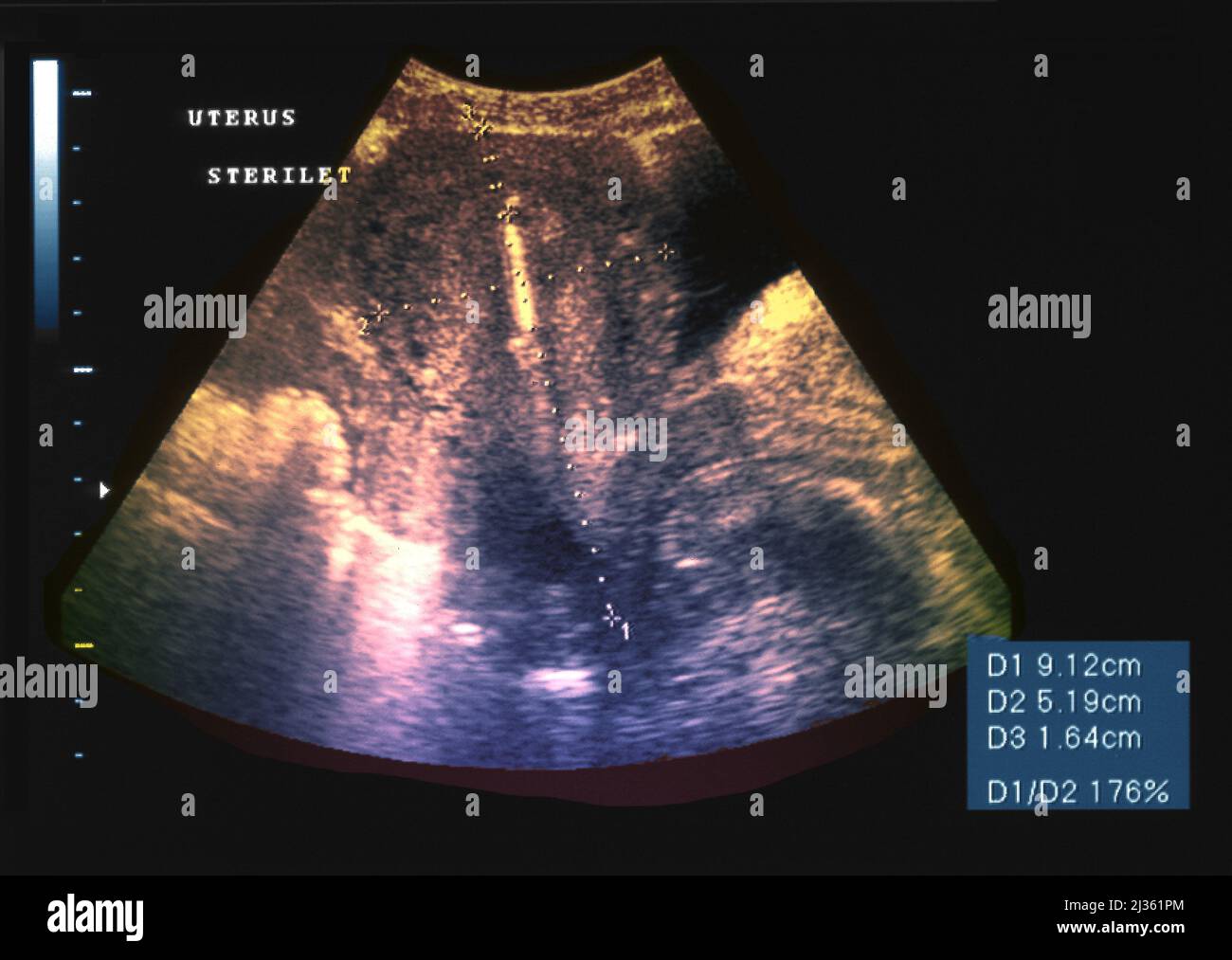 Normal uterus, ultrasound scan Stock Photo - Alamy