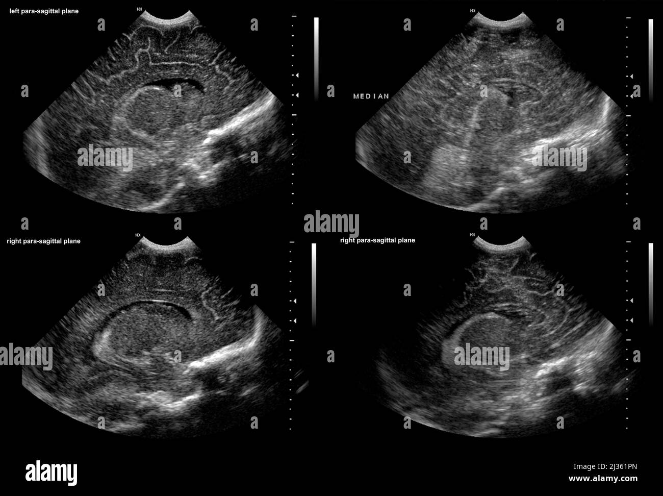 Premature baby normal brain development, ultrasound scans Stock Photo ...