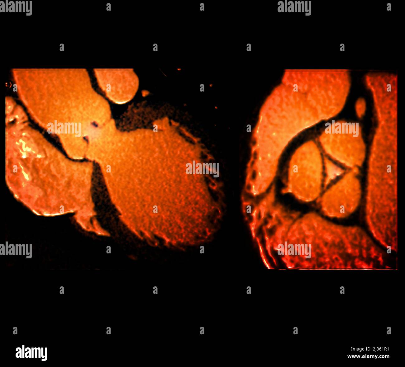 Aortic valve insufficiency, CT angiogram Stock Photo - Alamy