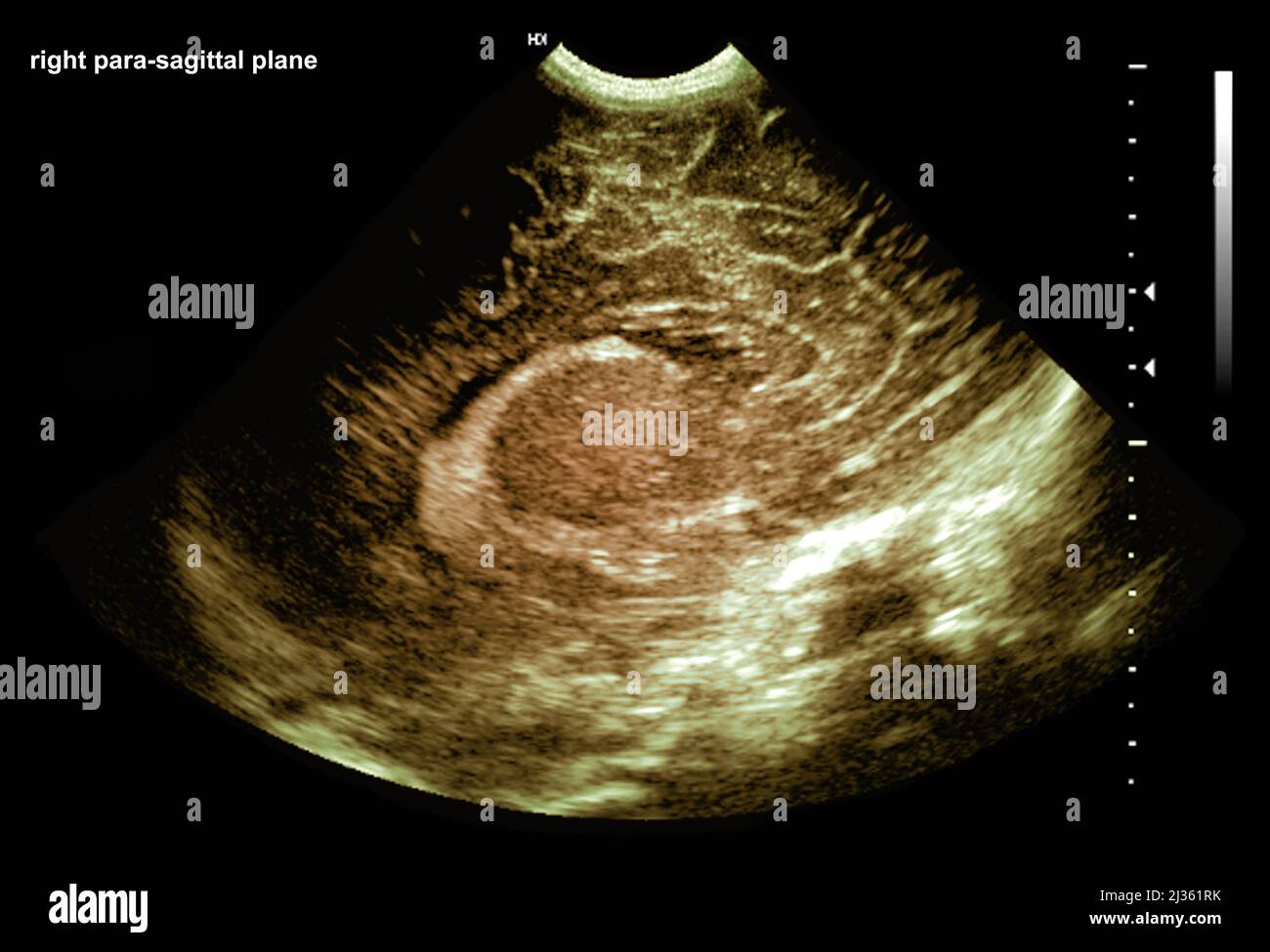 Premature baby normal brain development, ultrasound scan Stock Photo ...