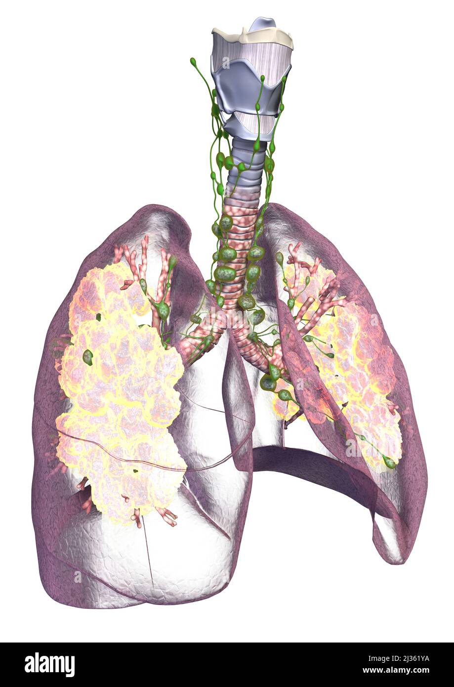 Lung cancer, illustration Stock Photo - Alamy