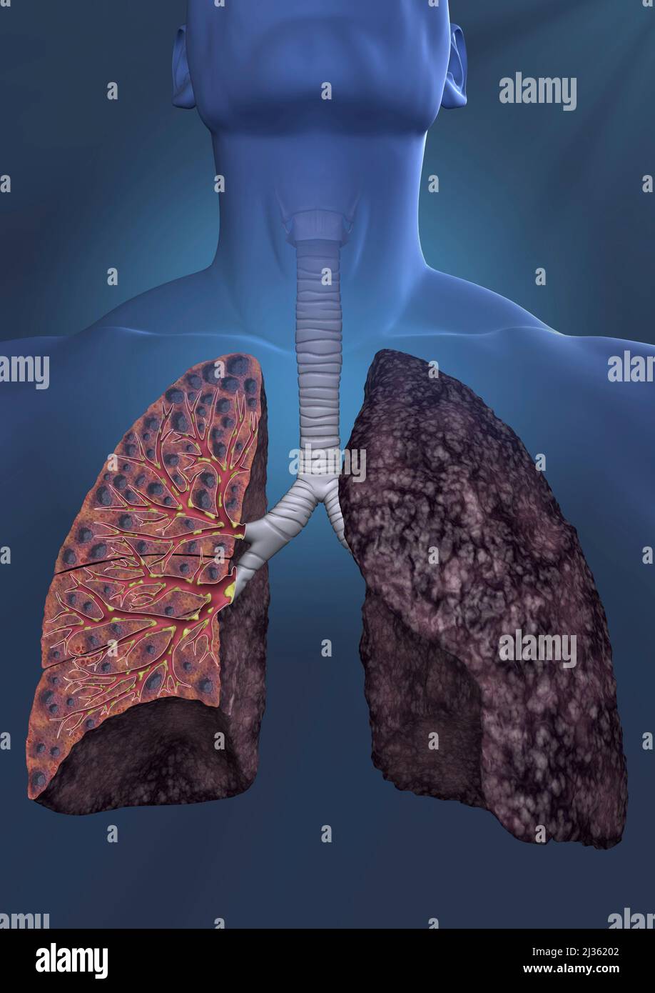Smoker's lungs, illustration Stock Photo - Alamy