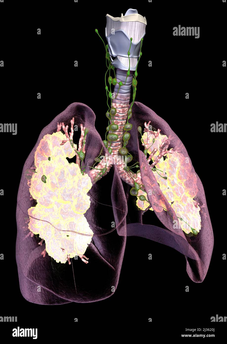 Lung cancer, illustration Stock Photo - Alamy