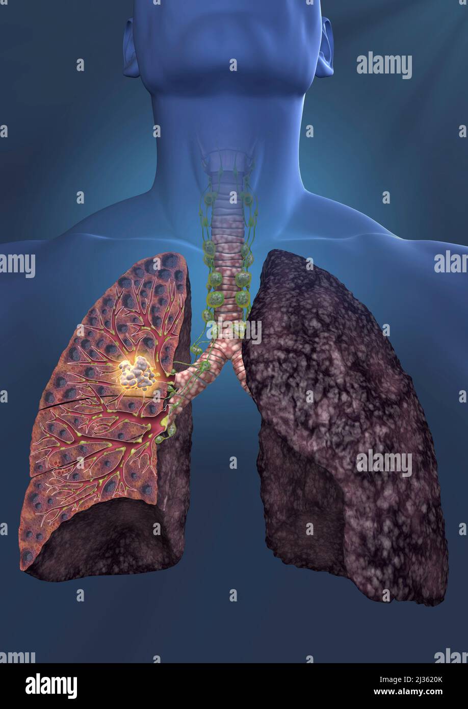 Smoker's lungs with oat cell carcinoma, illustration Stock Photo - Alamy
