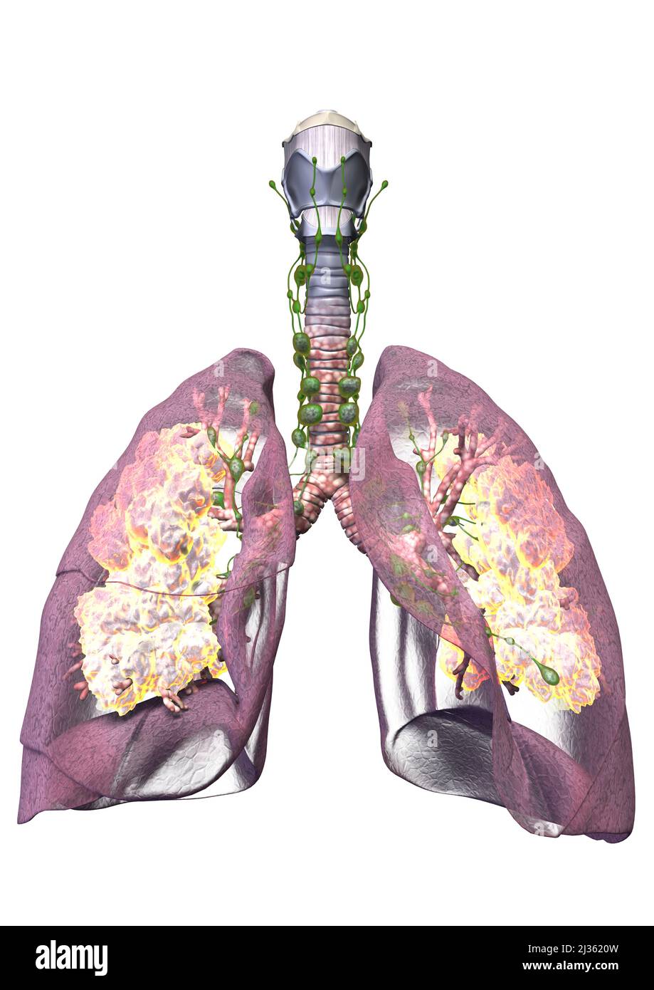 Lung cancer, illustration Stock Photo - Alamy