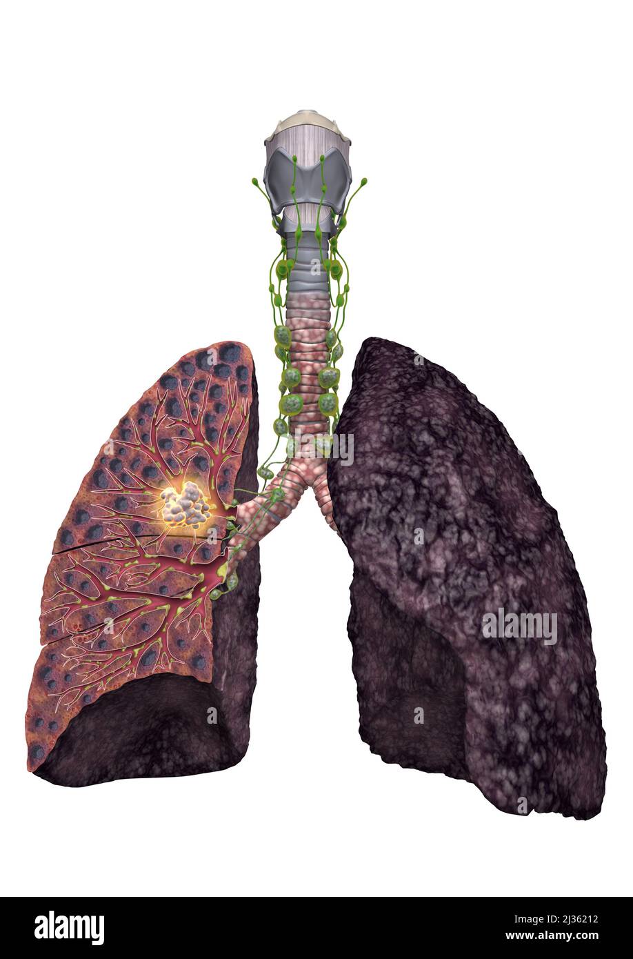Smoker's lungs with oat cell carcinoma, illustration Stock Photo - Alamy