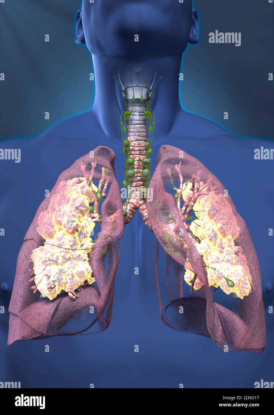 Lung cancer, illustration Stock Photo - Alamy