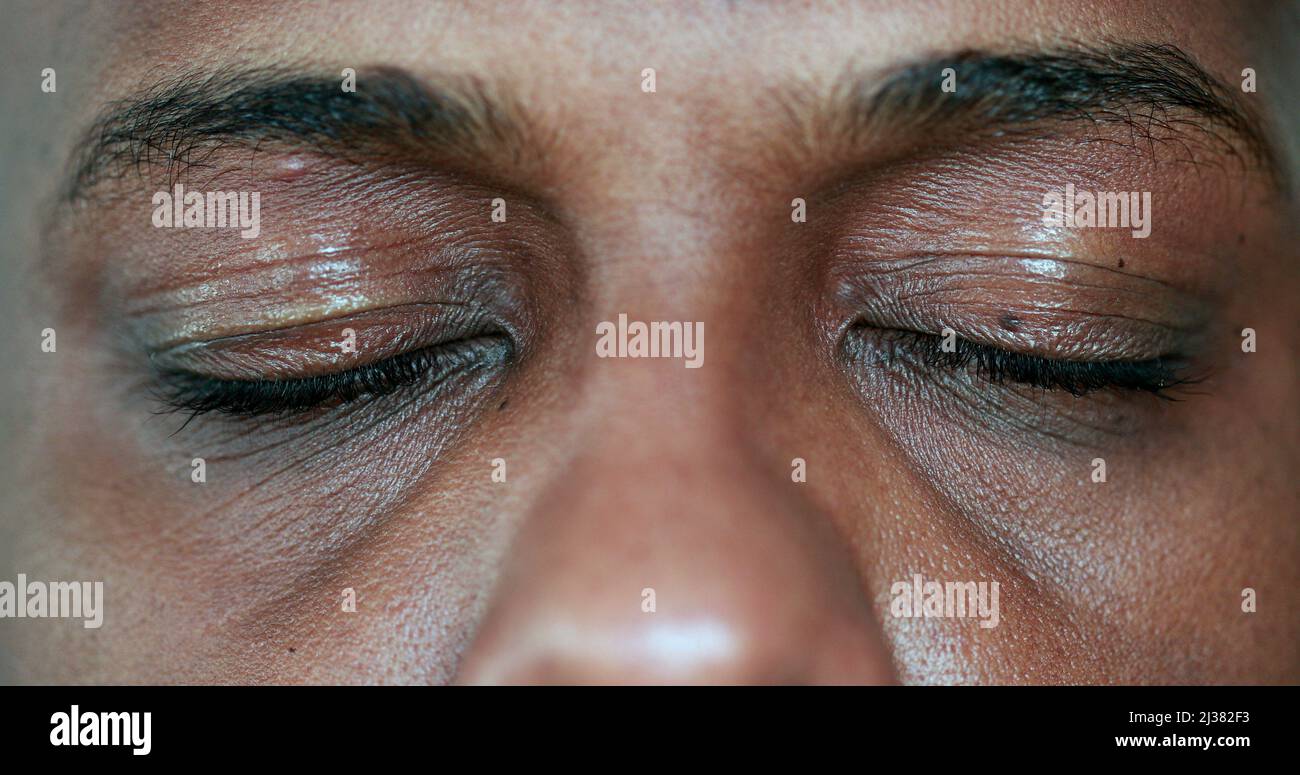 Acanthosis Nigricans Eyes