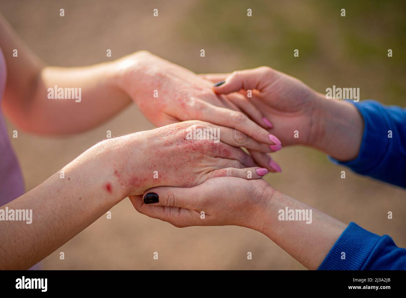 Close up dermatitis on skin, ill allergic rash eczema skin of patient , atopic dermatitis ...