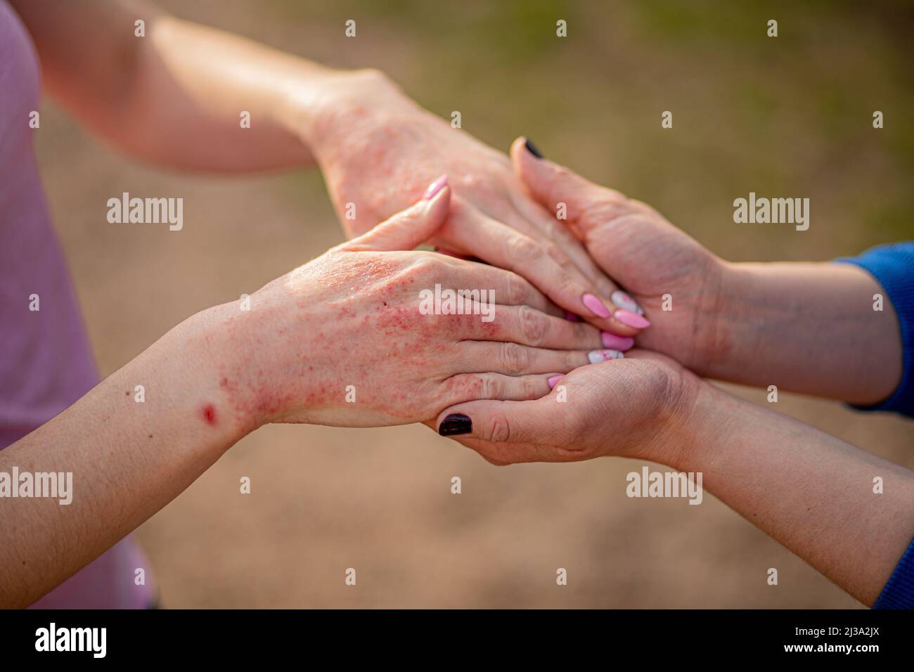 Close up dermatitis on skin, ill allergic rash eczema skin of patient , atopic dermatitis ...