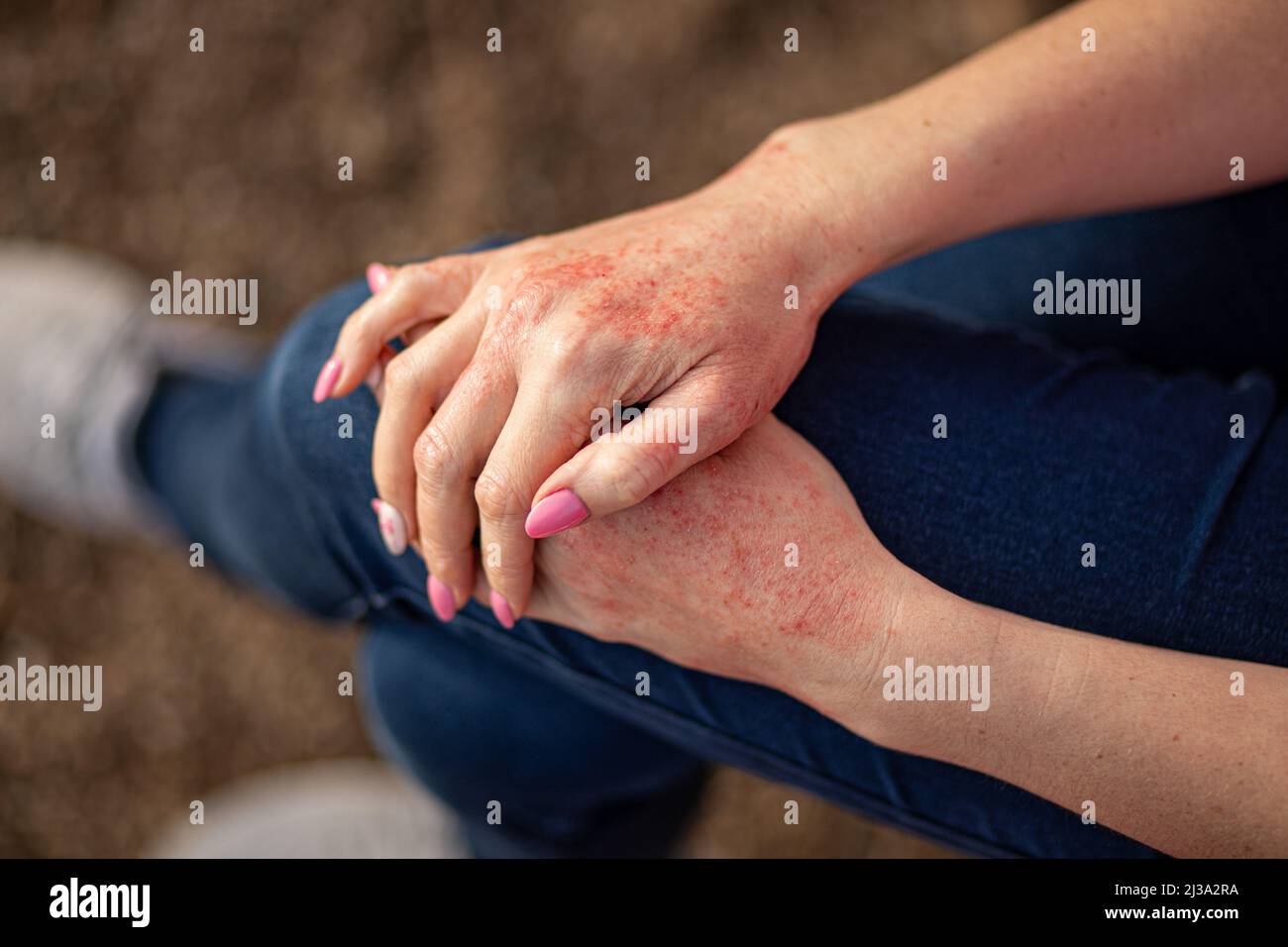 Close up dermatitis on skin, ill allergic rash eczema skin of patient , atopic dermatitis ...