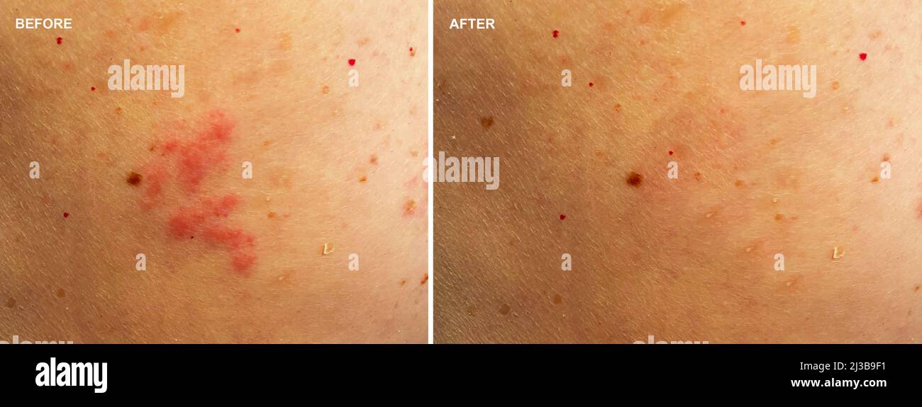 Photo before and after skin irritation treatment. Rash on a woman skin ...