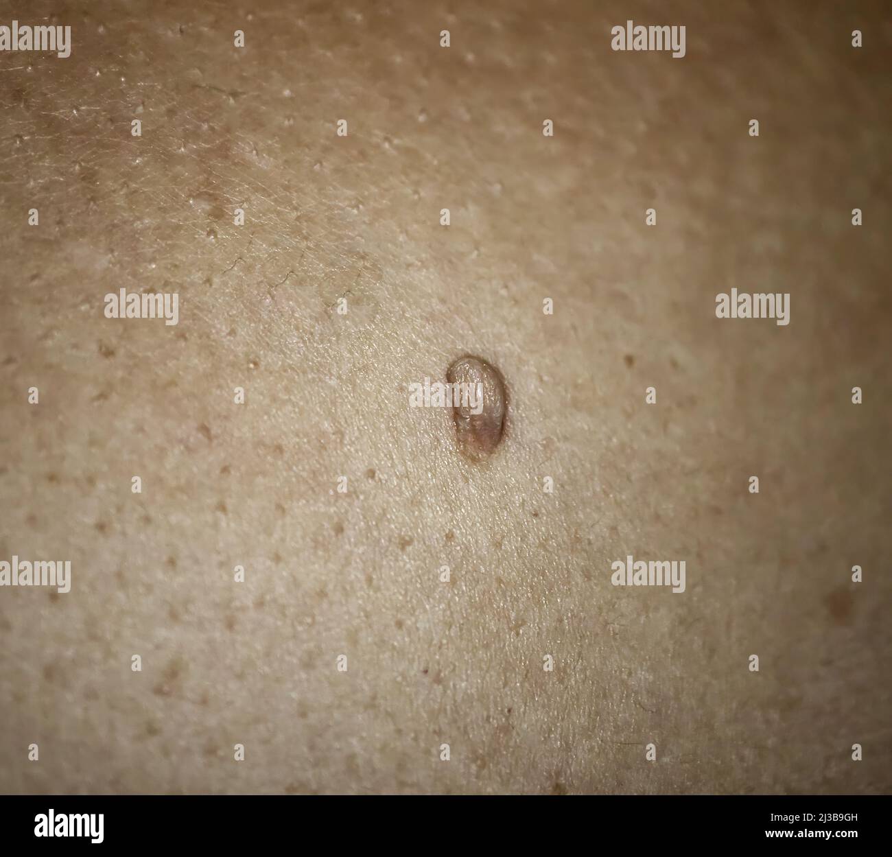 Large Papilloma on woman skin. Medical health photo. Dermatology ...