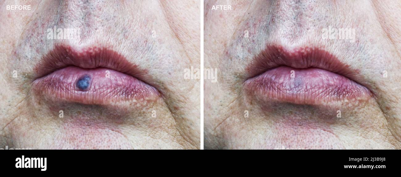 Image before and after removal of venous lake on lip of mouth Stock ...