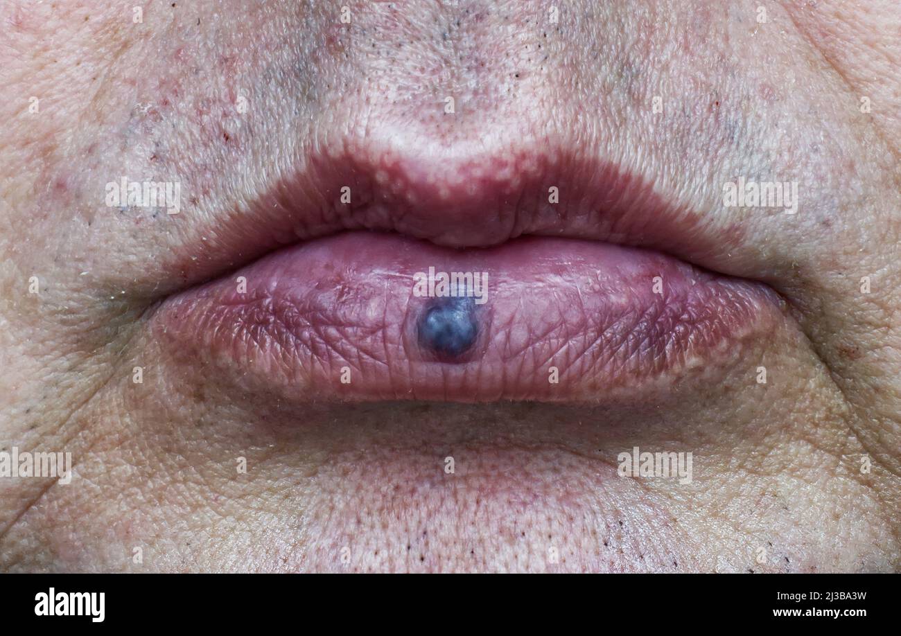 Venous lake hi-res stock photography and images - Alamy