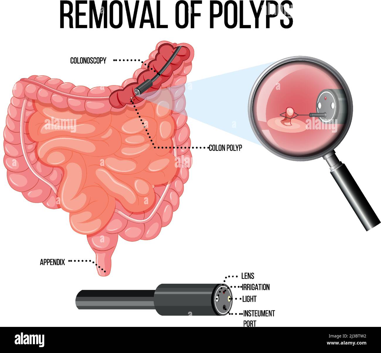 Diagram showing removal of polyps illustration Stock Vector Image & Art ...