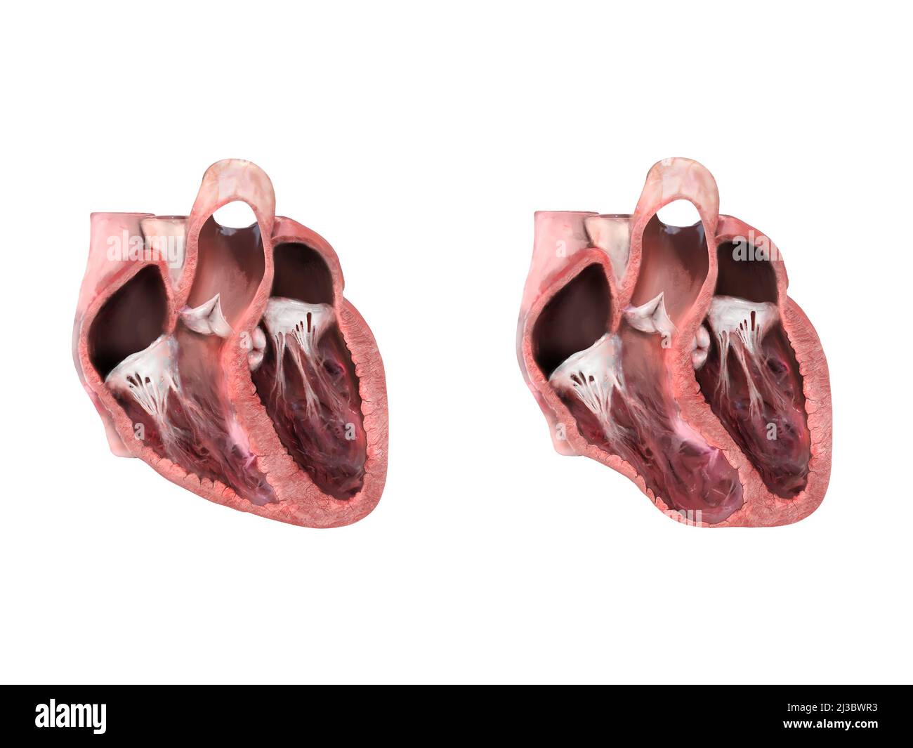 healthy heart versus aneurysm,heart anatomy, Left ventricular aneurysm ...