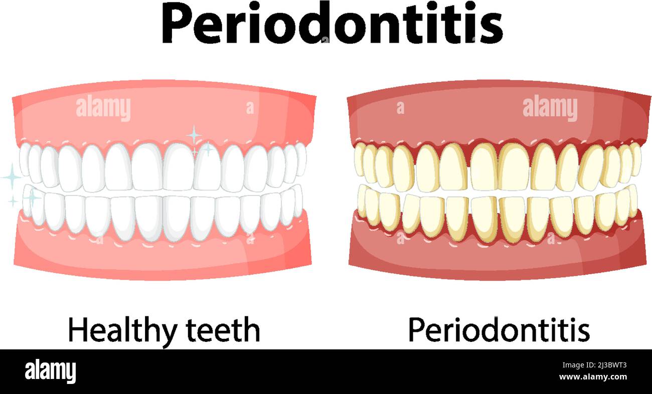 Infographic of human in periodontitis illustration Stock Vector Image ...