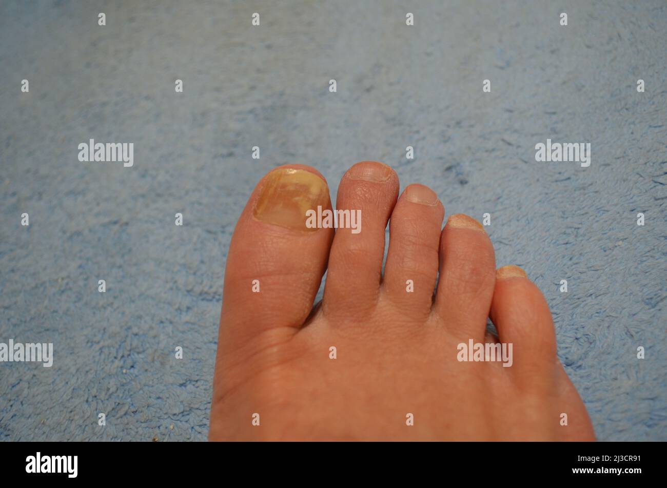 Fungus toe hi-res stock photography and images - Alamy