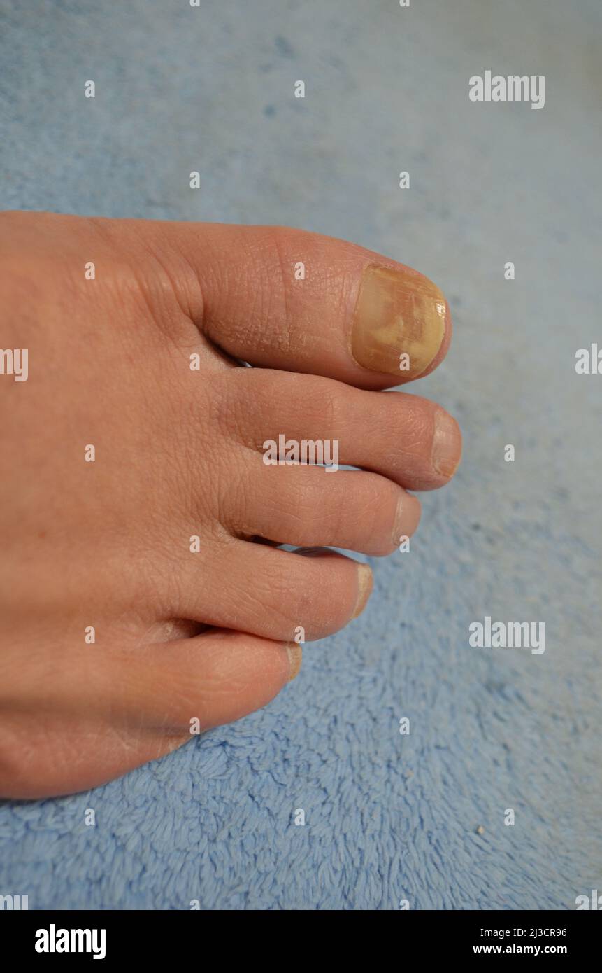 Toenail Fungus (big toe + four toes) 3 Stock Photo - Alamy