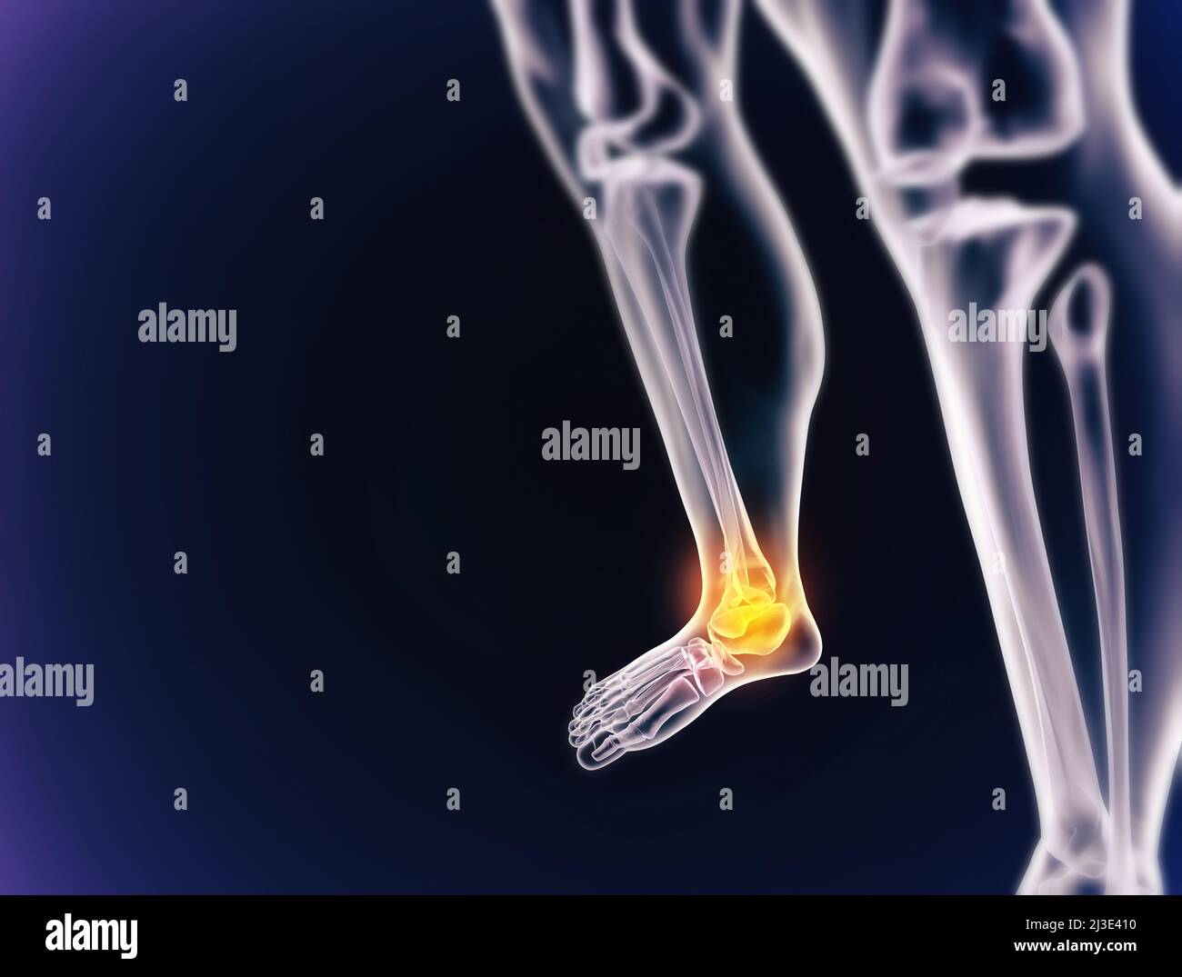 When inflammation strikes. A cgi view of an inflamed joint isolated on ...