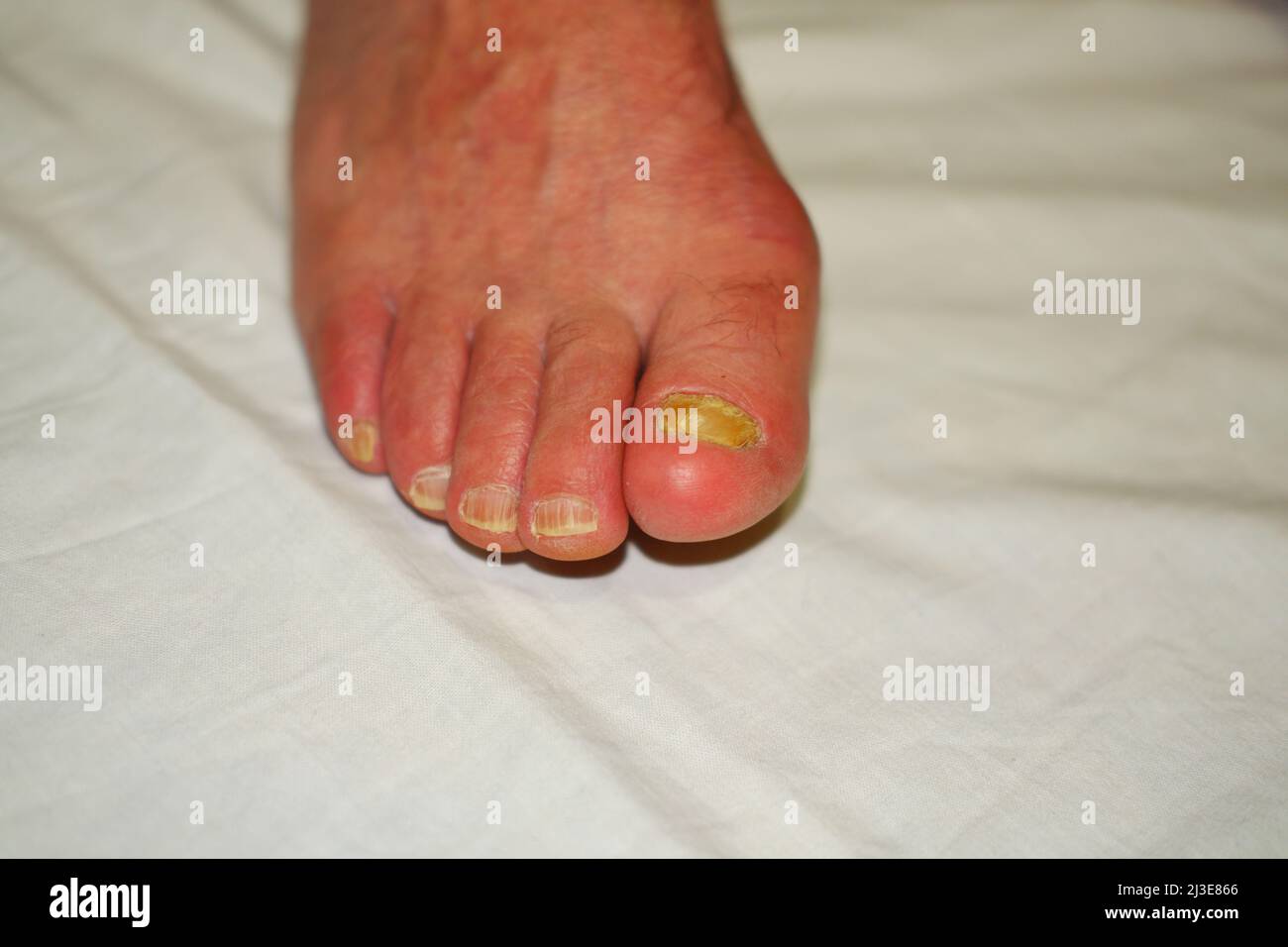 Fungal infection nail hi-res stock photography and images - Alamy