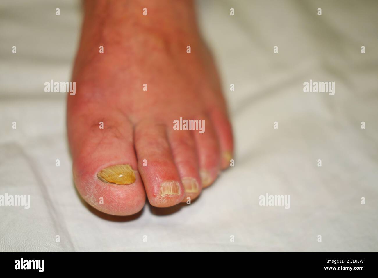 Fungal toenail infection hi-res stock photography and images - Alamy