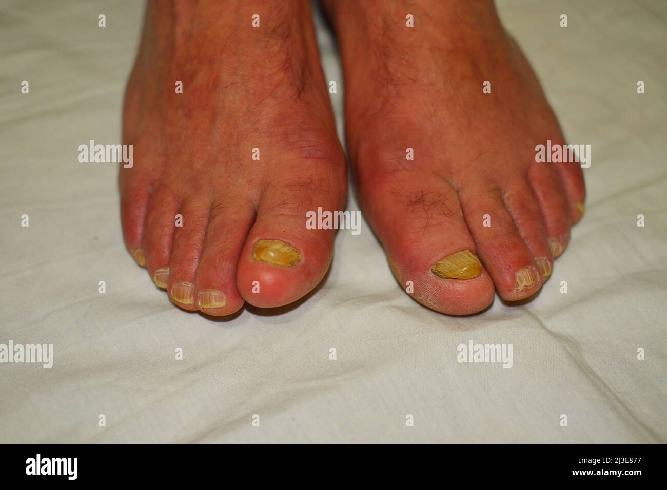 Foot infection care hi-res stock photography and images - Alamy
