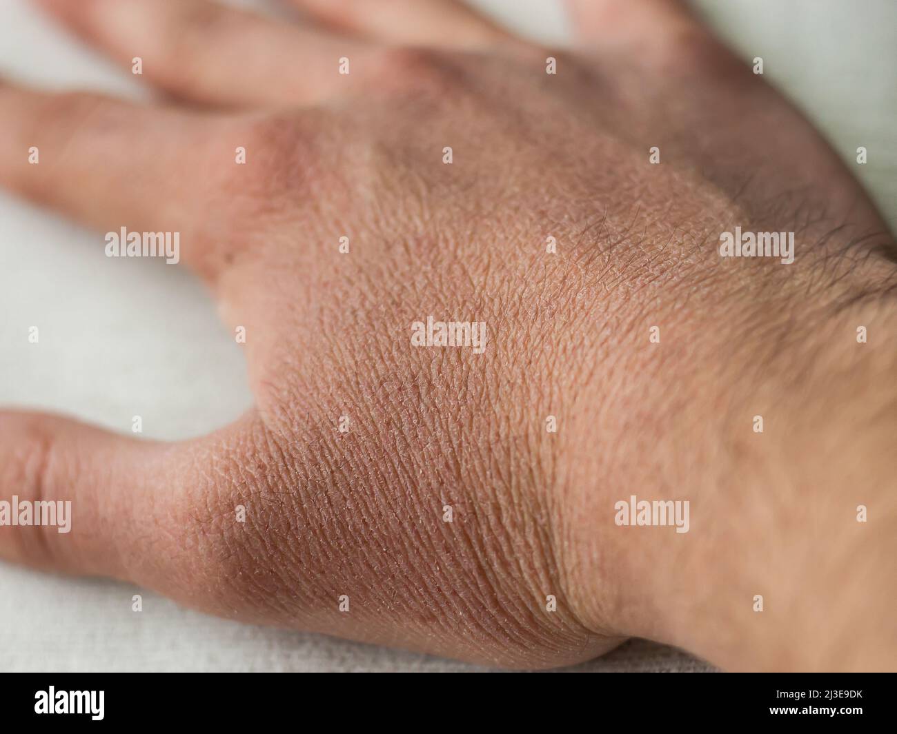 Withered hand hi-res stock photography and images - Alamy