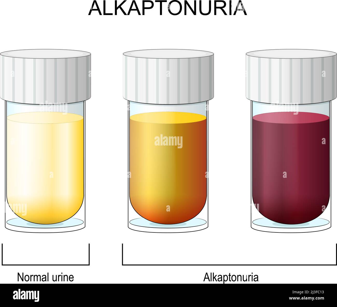 Alkaptonuria. Color change in Urine from Normal to alkaptonuria ...