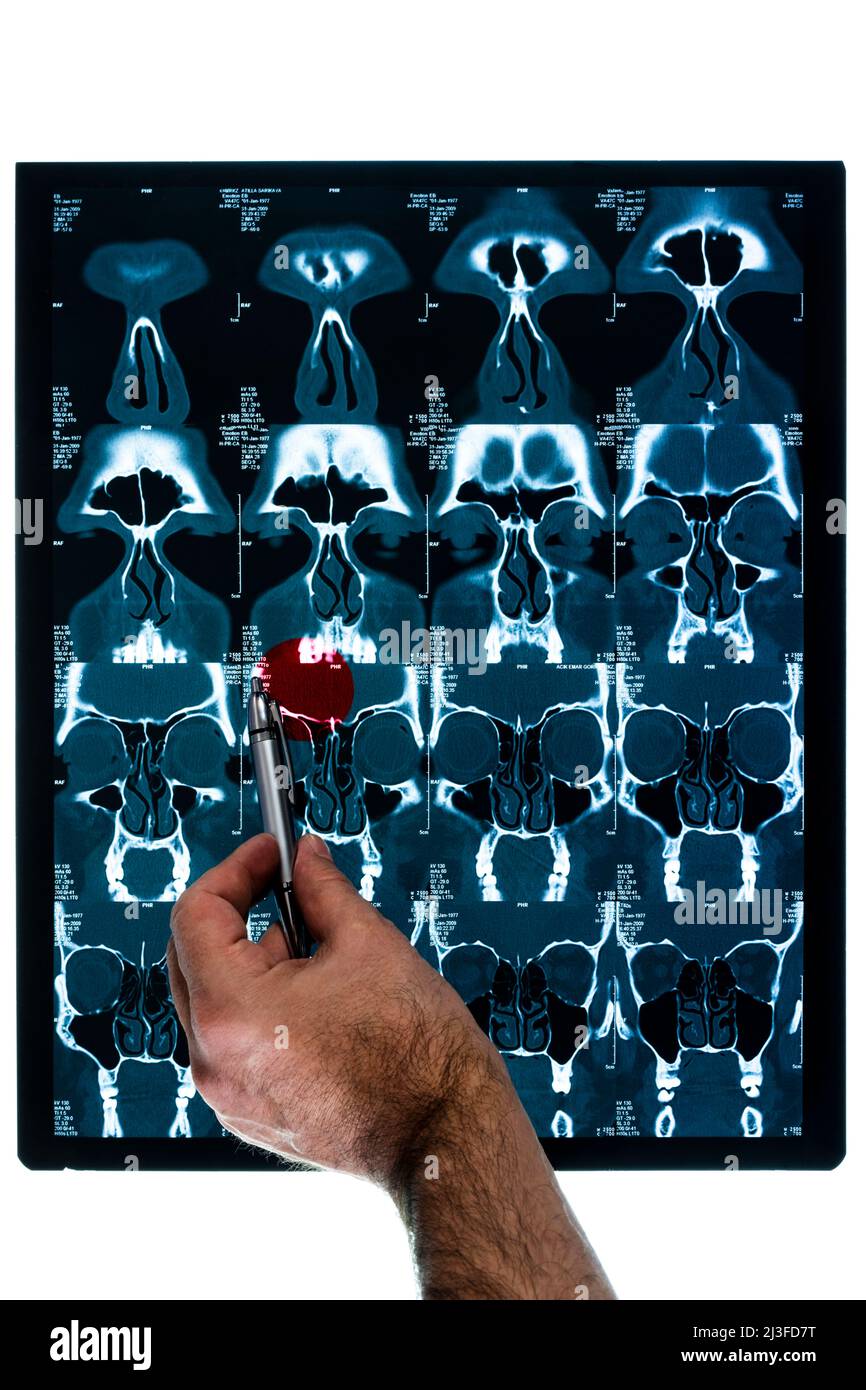 Intranasal x-ray, sinusitis, adenoid. Skull x-ray image of Human head ...