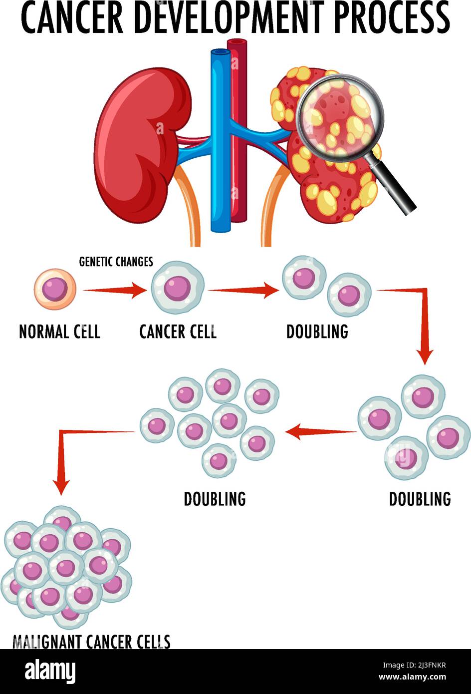Diagram showing cancer development process illustration Stock Vector ...