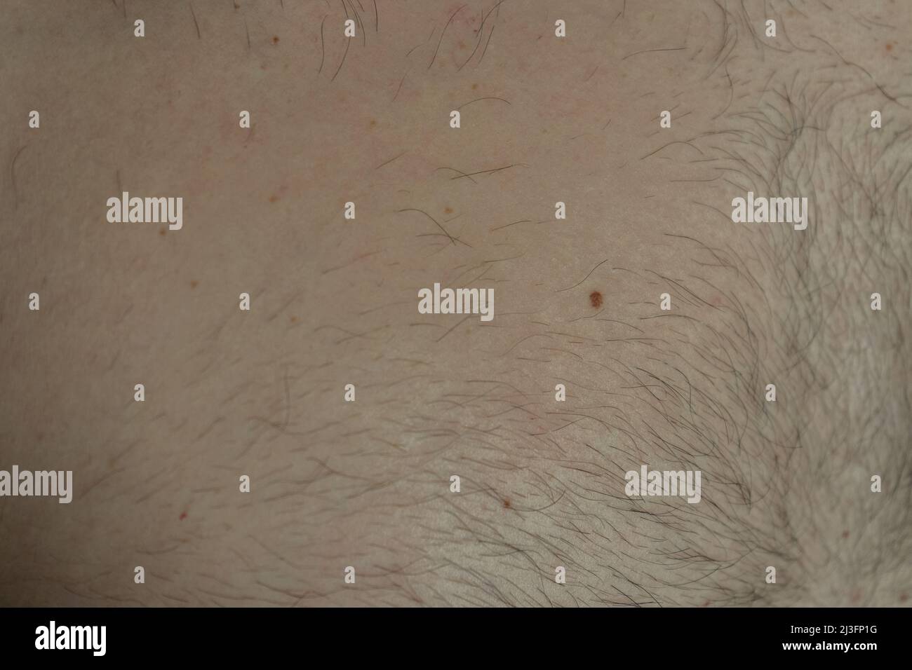 Moles on different parts of the body Stock Photo - Alamy