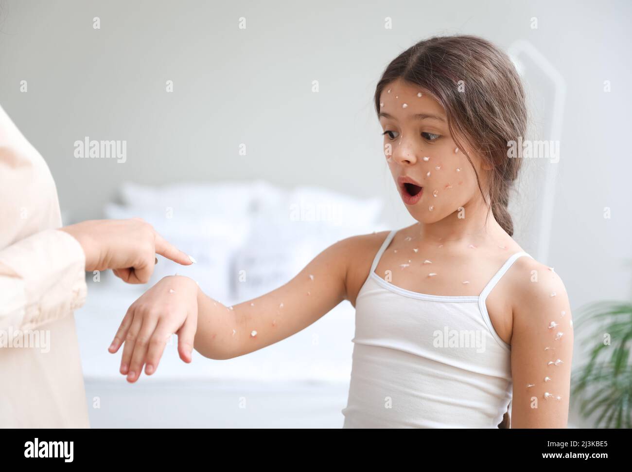 Mother applying remedy on skin of her little daughter ill with ...