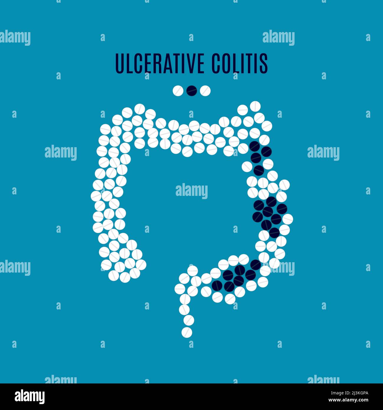 Ulcerative colitis, conceptual illustration Stock Photo - Alamy