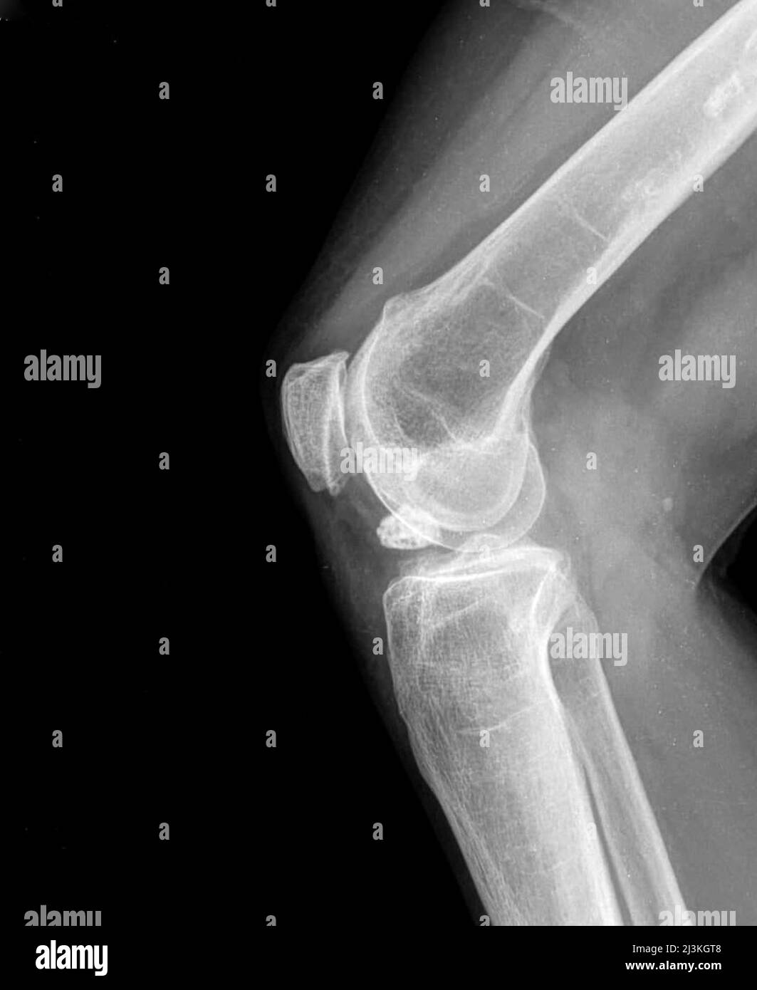 Hoffa's Fat Pad syndrome, X-ray Stock Photo - Alamy