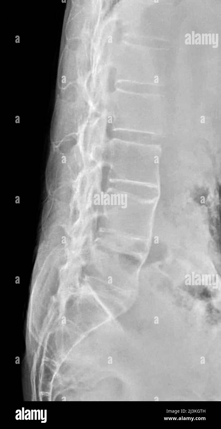 Ankylosing Spondylitis Bamboo Spine