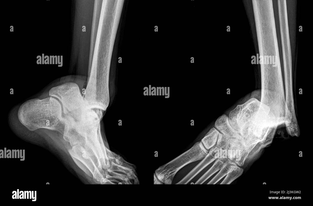 Ankle Dislocation Diagram