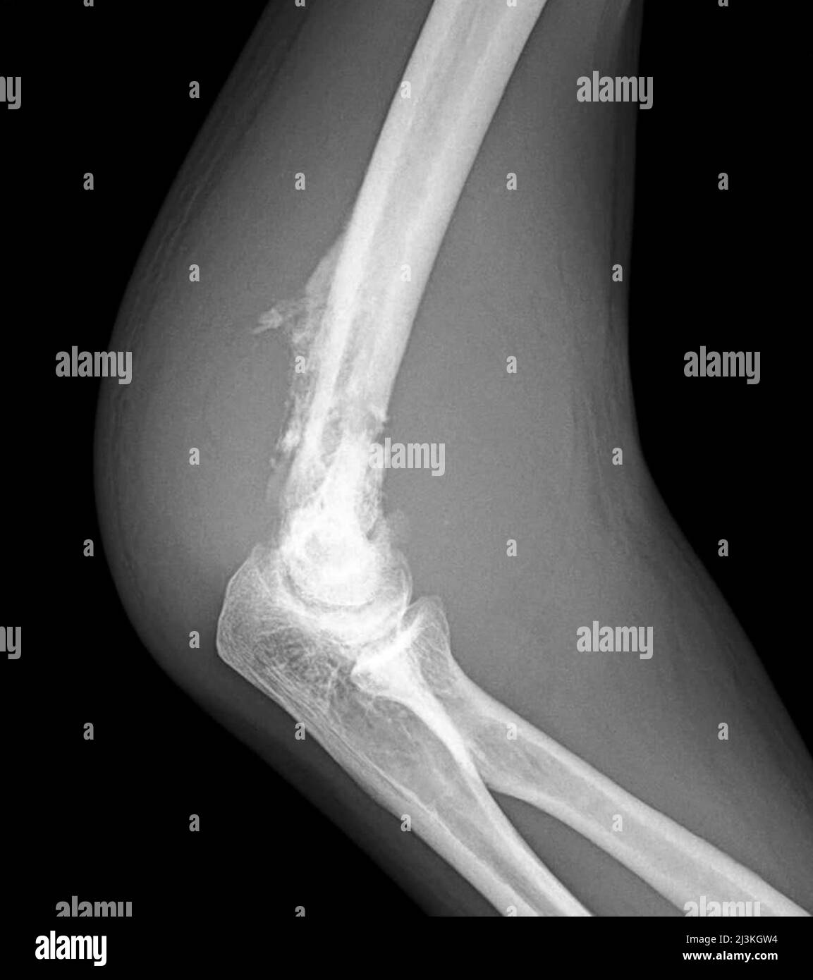 Osteogenic Sarcoma Codmans Triangle