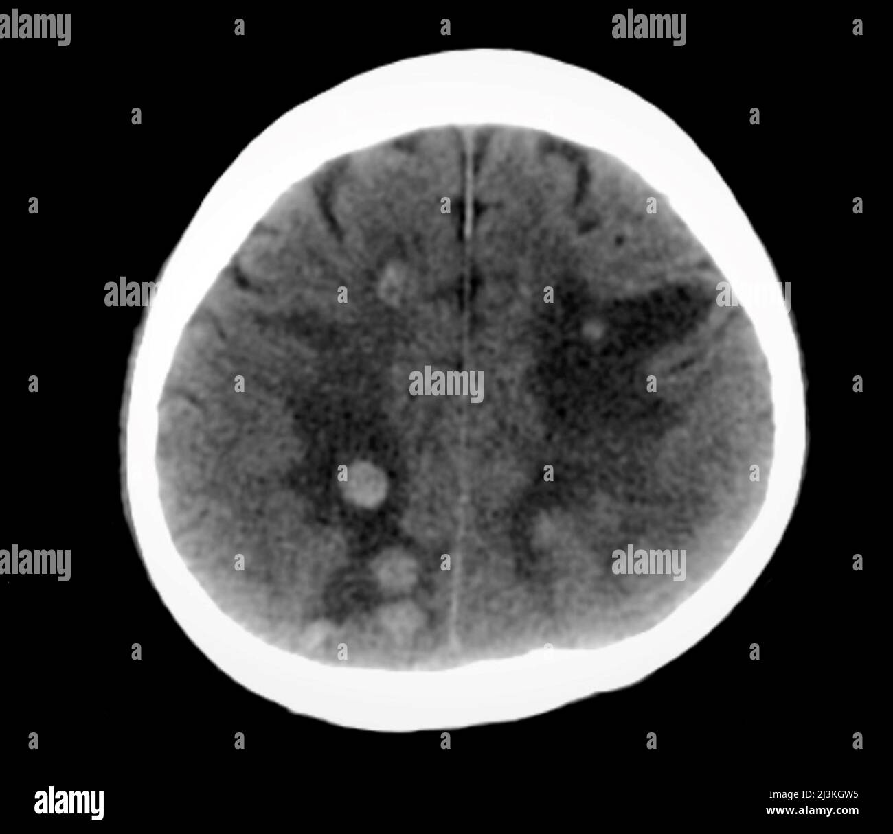 Haemorrhagic brain metastases, CT scan Stock Photo - Alamy
