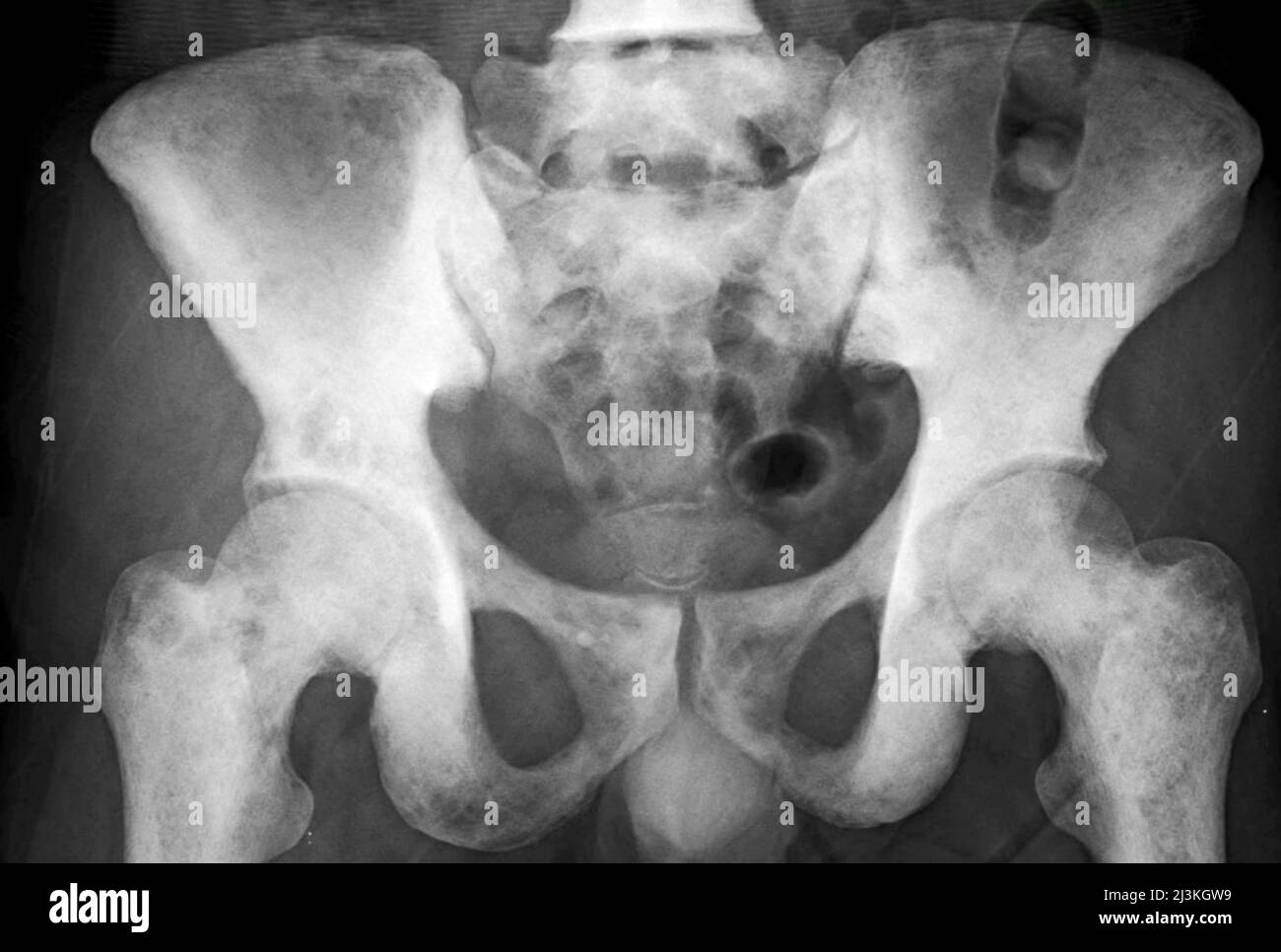Bone metastasis of the pelvis, X-ray Stock Photo - Alamy
