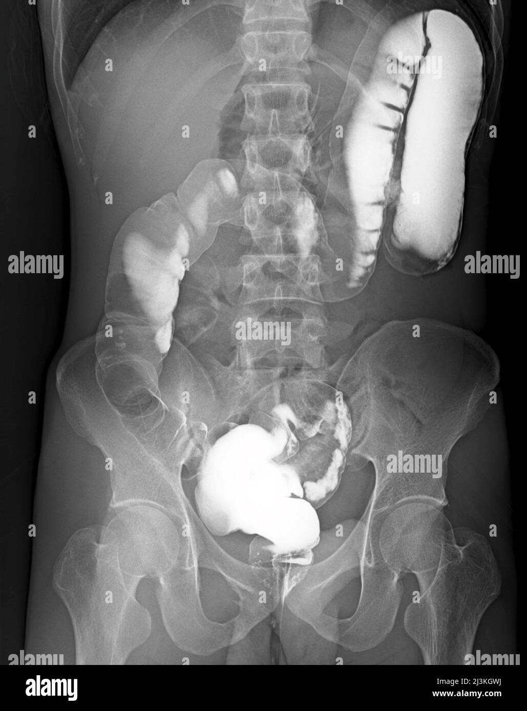 Colon malrotation, X-ray Stock Photo - Alamy